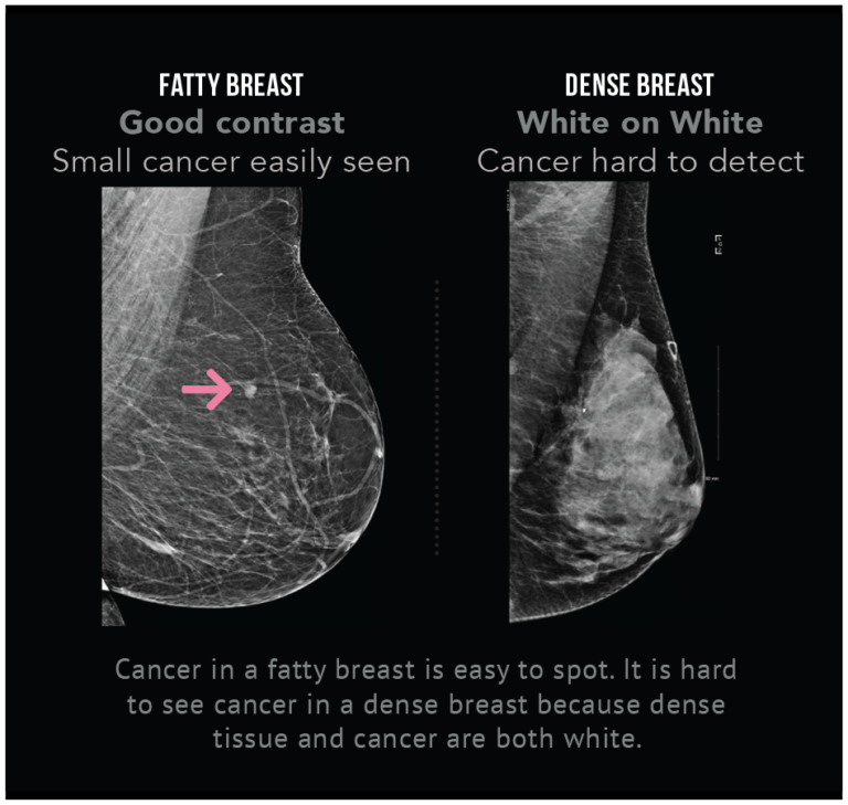 Dense Breasts | Dense Breasts Canada | Find out your breast density.